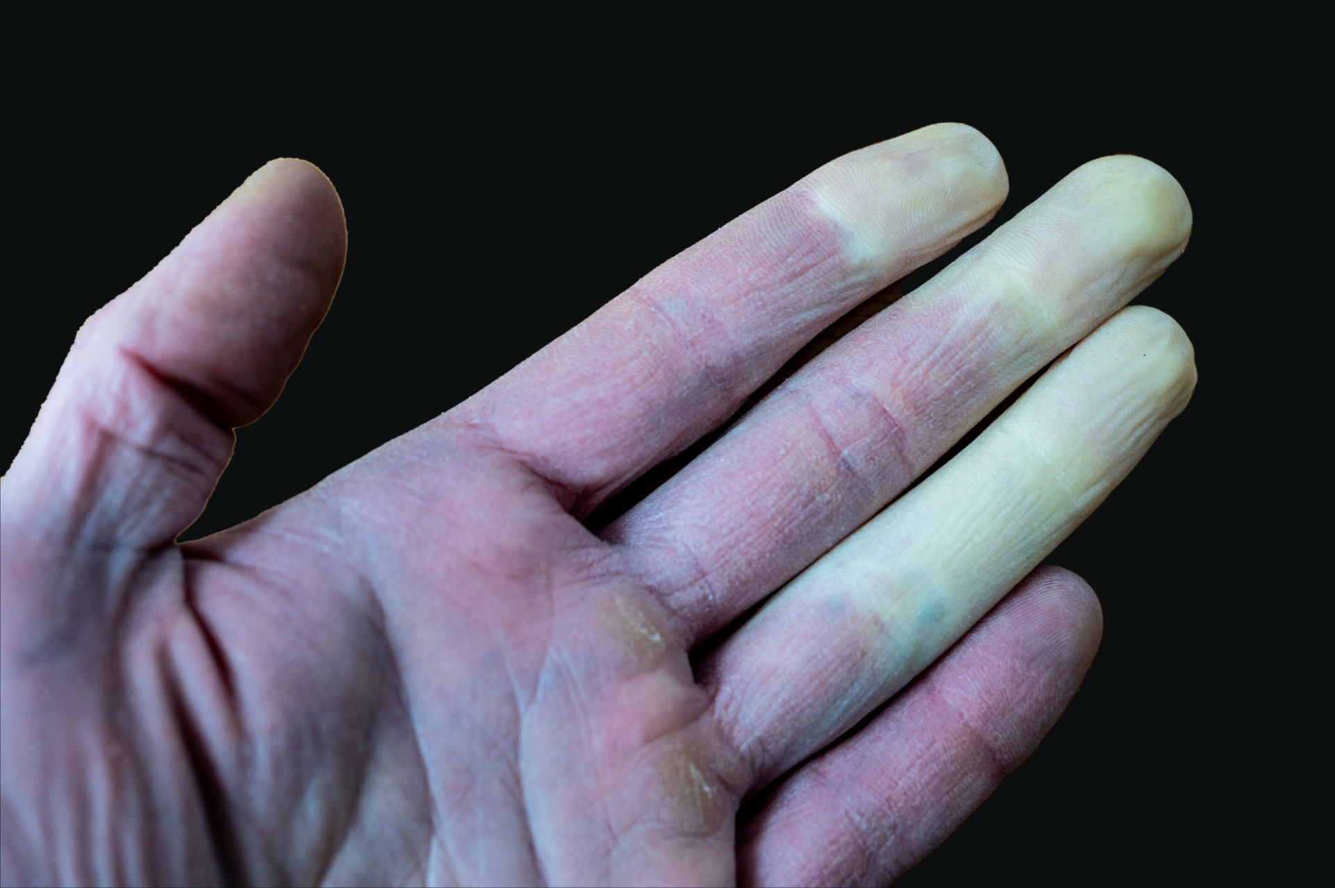 What exactly is the medical condition known as Raynaud's phenomenon?