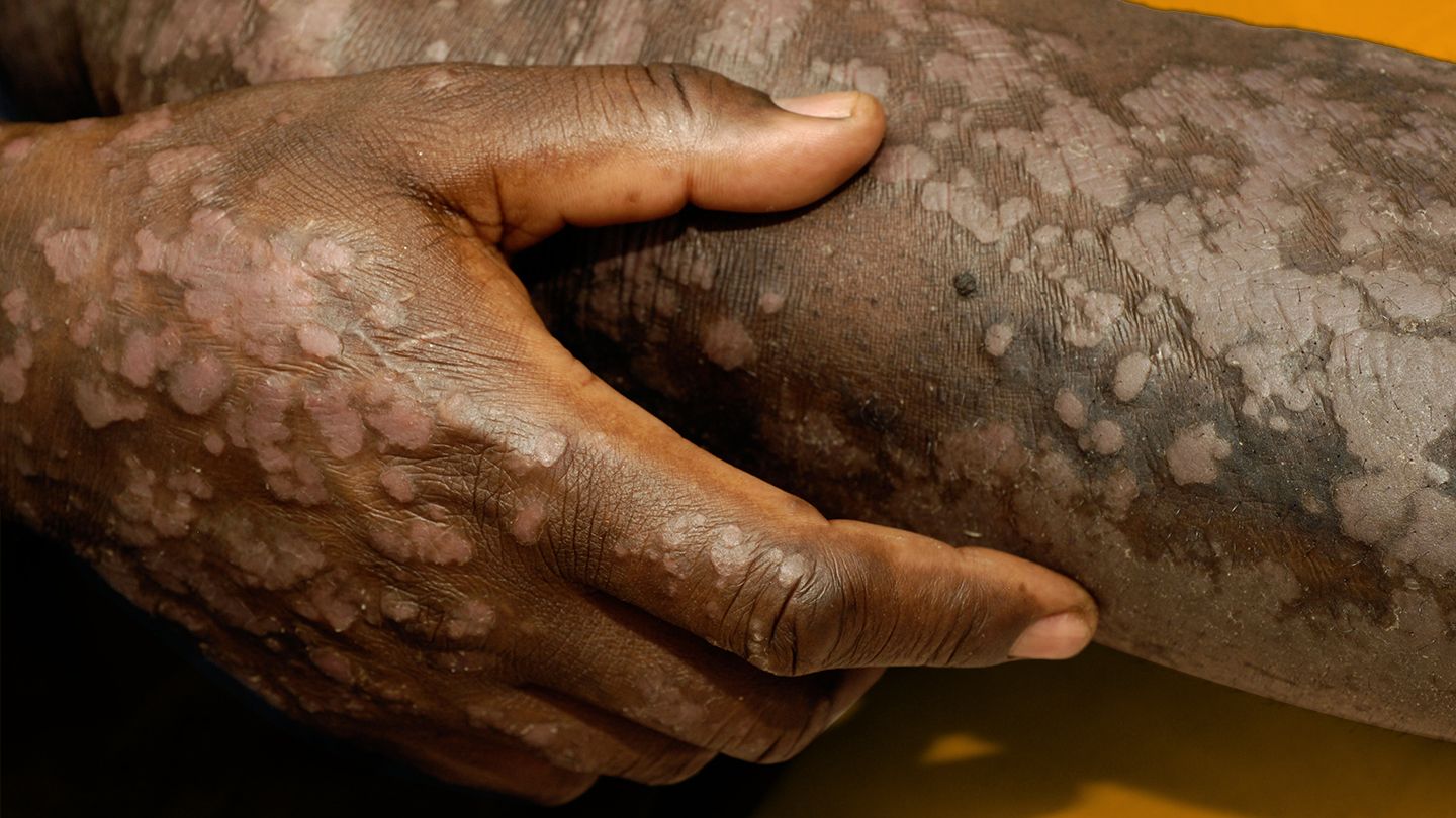What Black Patients Need To Know About The Effects of Psoriasis
