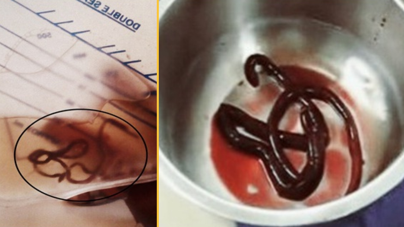 Diagnostic dilemma: A man who couldn't pee had been infected by one of ...