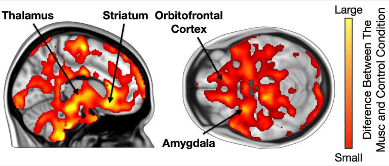 Favorite music sets the brain's opioids in motion, imaging study reveals
