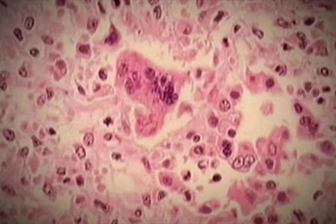 Measles poses risk to pregnant women amid West Texas outbreak
