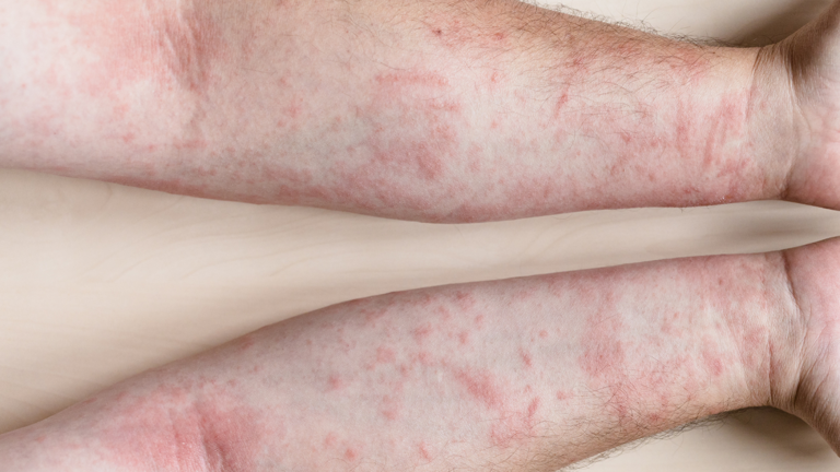 Summer heat rashes: What makes it worse and how to prevent them