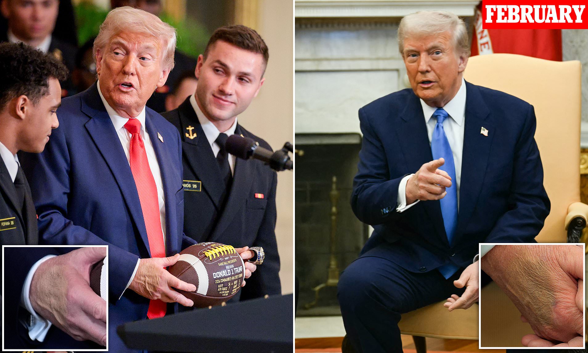 Large bruise reappears on Trump's hand - doctor claims to know why