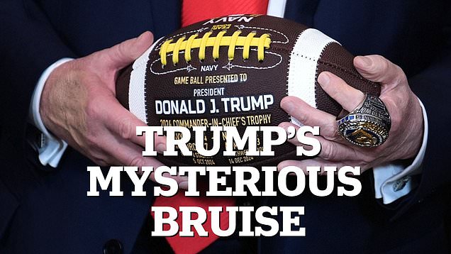 Mysterious large bruise reappears on Donald Trump's hand