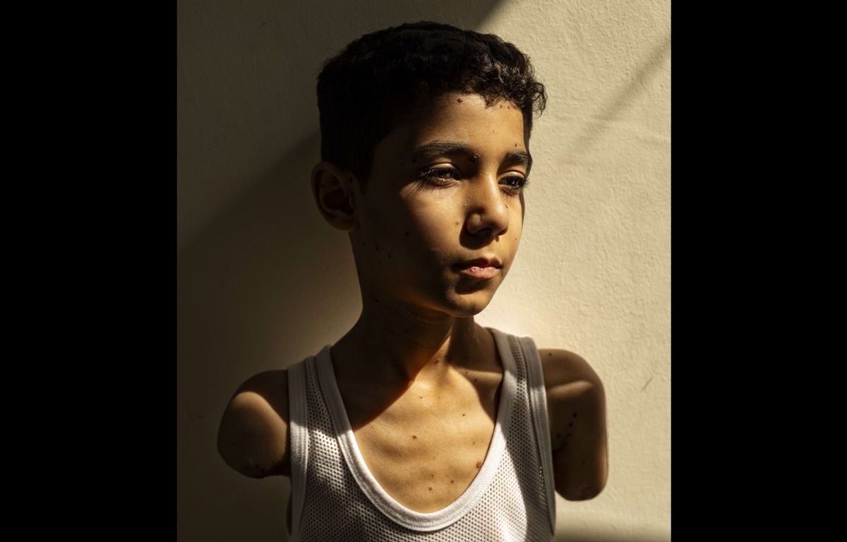 « World Press Photo 2025 » : Le portrait d’un enfant palestinien amputé ...