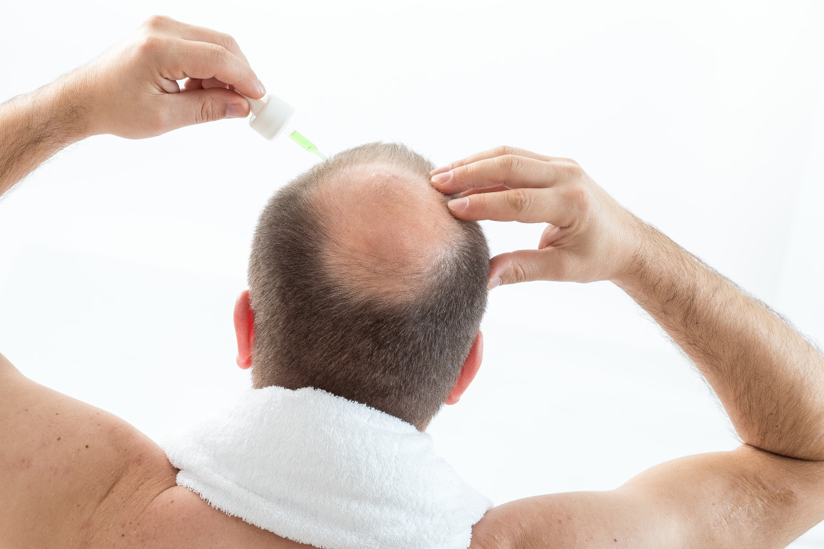Scientists Announce Big Breakthrough in Race to Cure Men's Baldness