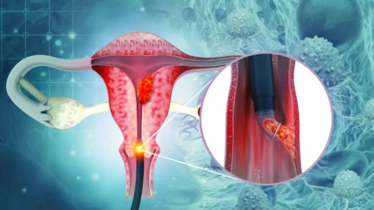 India Rolls Out Affordable HPV Test Kits to Fight Cervical Cancer