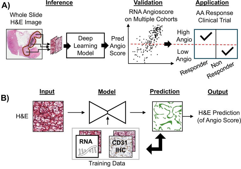 AI Predicts Kidney Cancer Drug Response Using Routine Pathology Slides