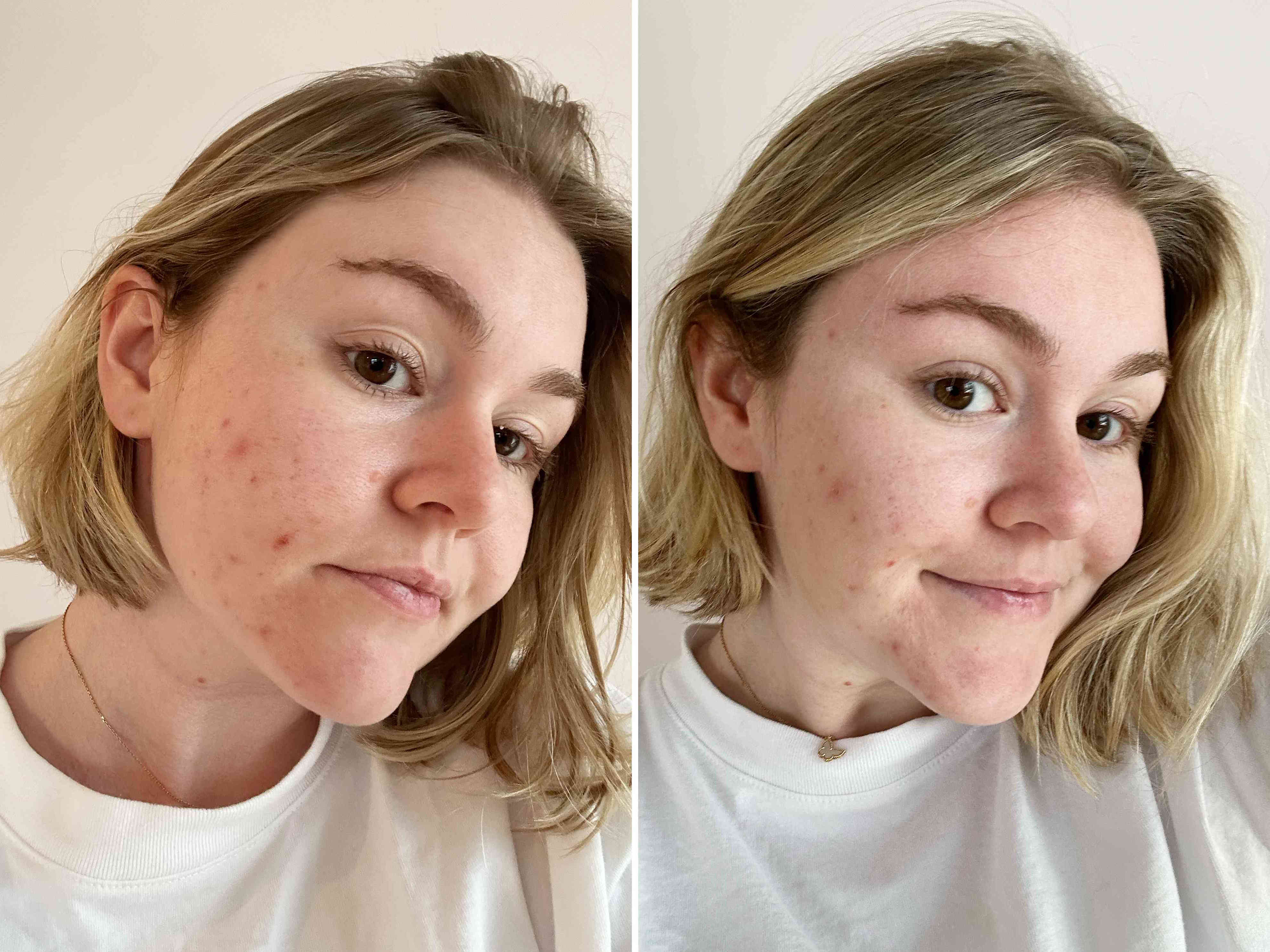 Reddit Convinced Me to Try This Genius $26 Pimple-Clearing Acne Hack
