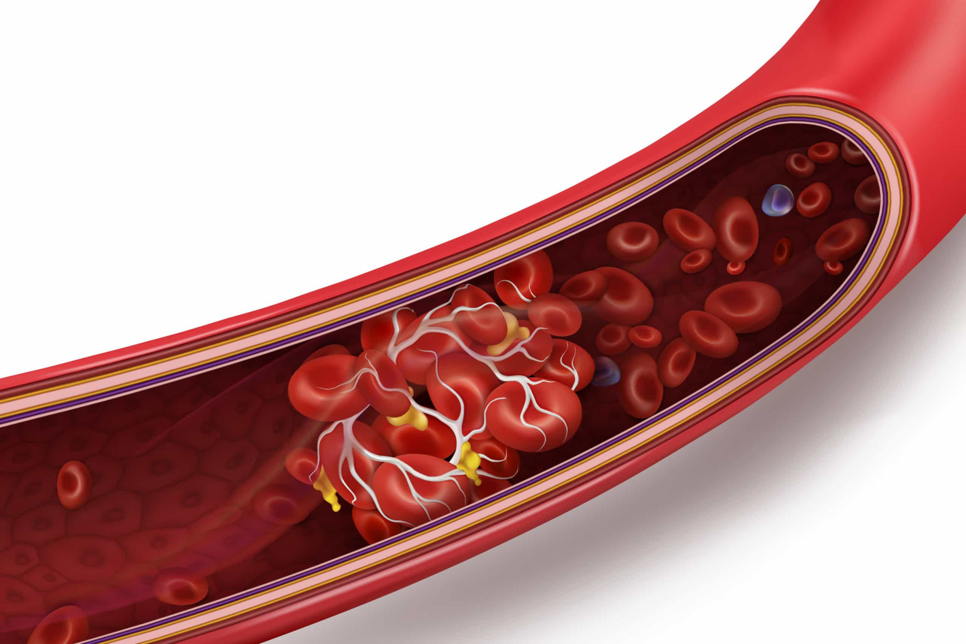 What to know about blood clots: risks and prevention