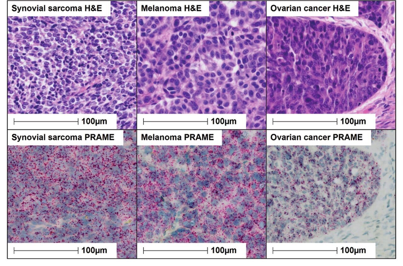 Novel cell therapy shows promising results in advanced tumor diseases