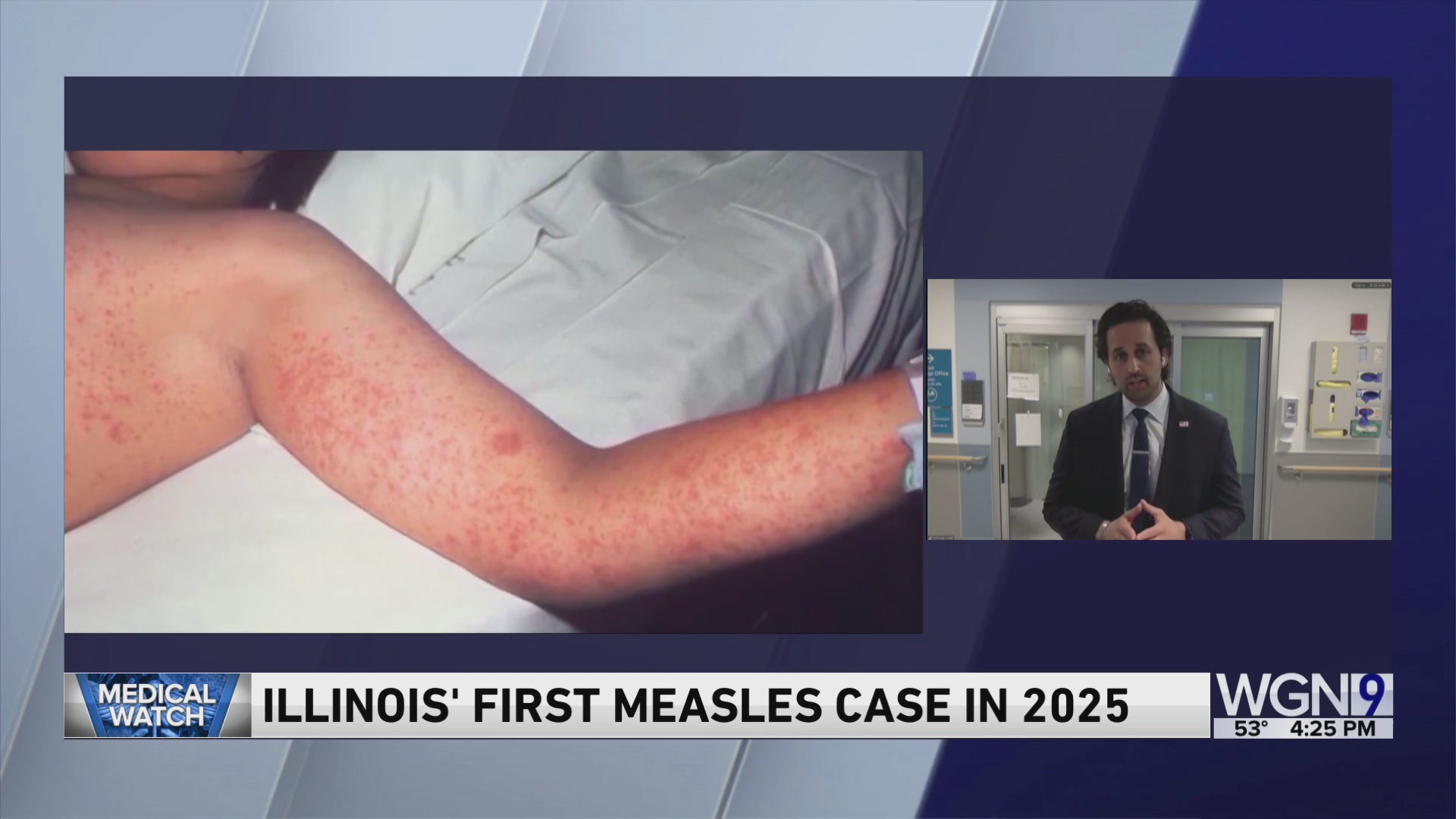 Downstate Illinois reports 1st measles case of 2025; local physician ...