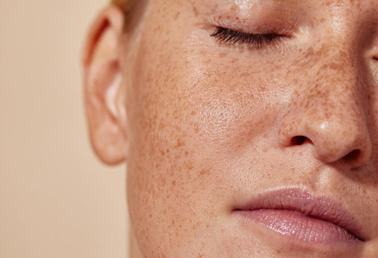 Freckle or melanoma? How to tell the difference.