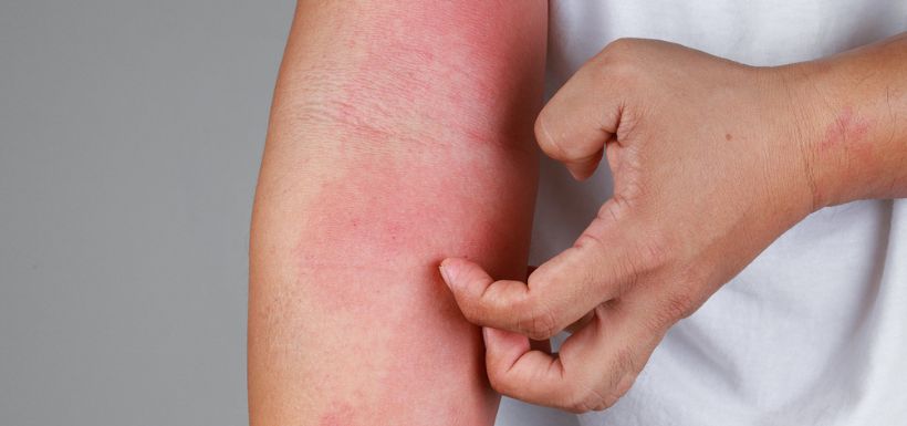 Prise en charge de la dermatite atopique : dernières recommandations