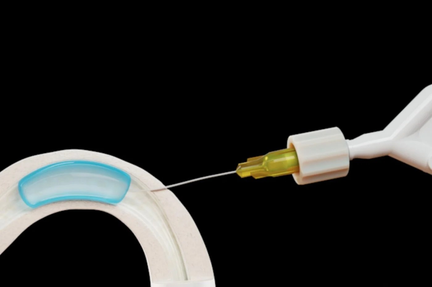 Reversible male birth control injectable lasts 2 years, moves to phase ...