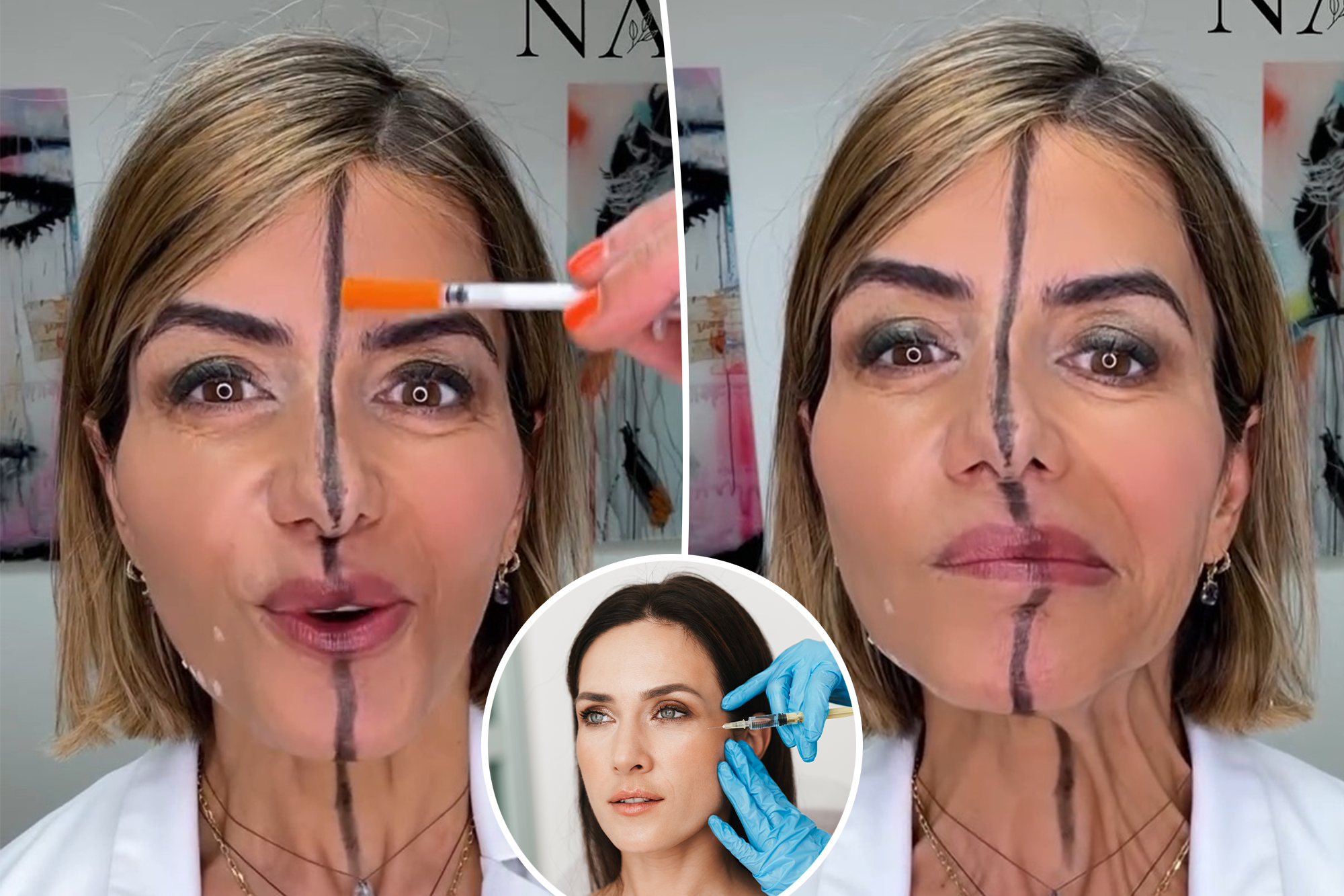 Doctor injects Botox into only one side of her own face — revealing an ...