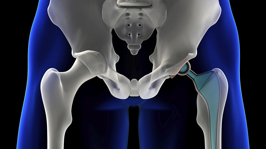 Hip Bursitis in Athletes