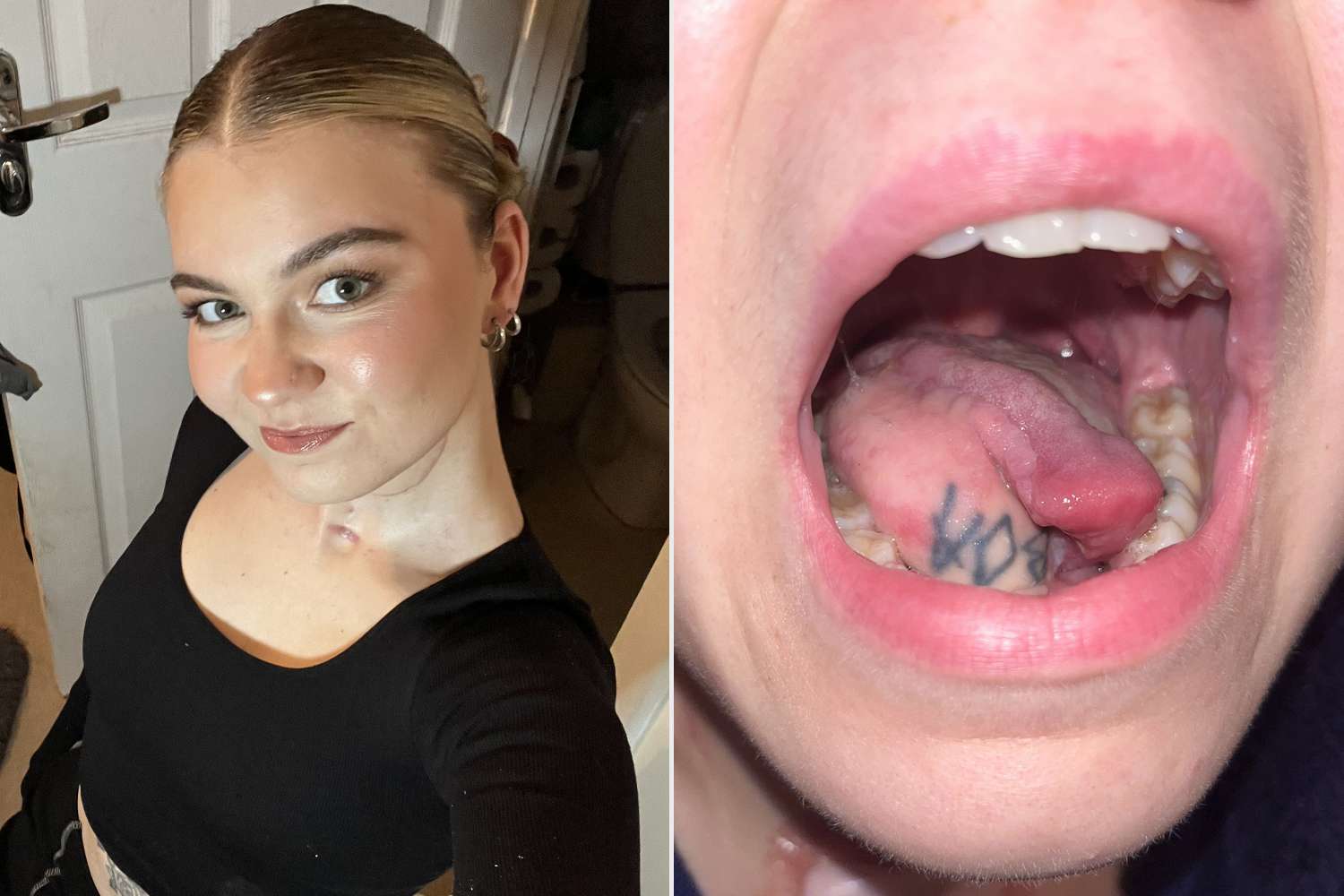 Woman's Tongue Removed After She Was Diagnosed with Mouth Cancer at 23 ...