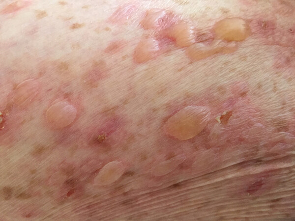 FDA, ‘ZEVASKYN’ 승인…난치성 RDEB 유전자 치료제 첫 허가