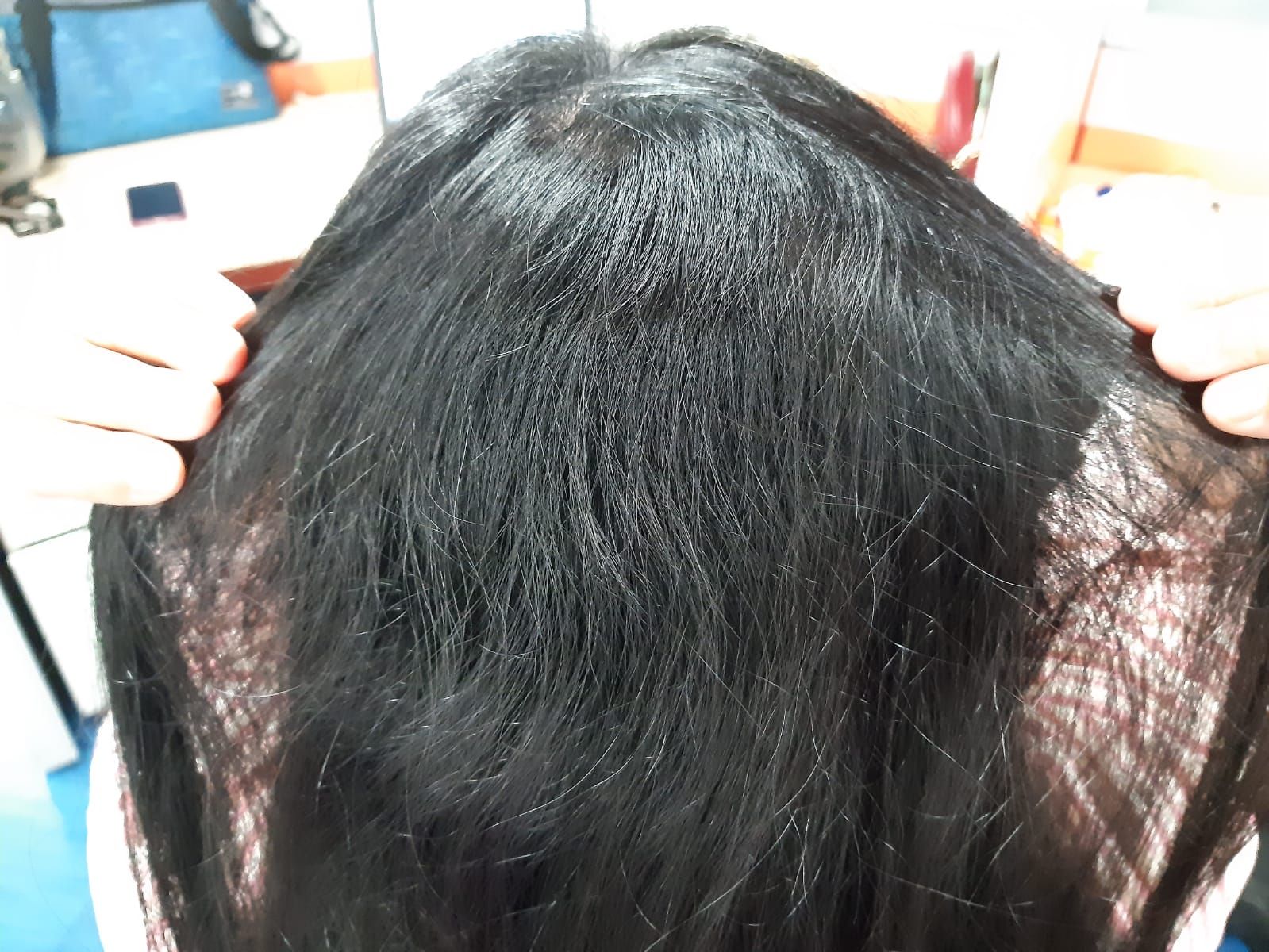 Umur 17 Tahun Ada uban, Apakah Normal? Ini Penjelasannya