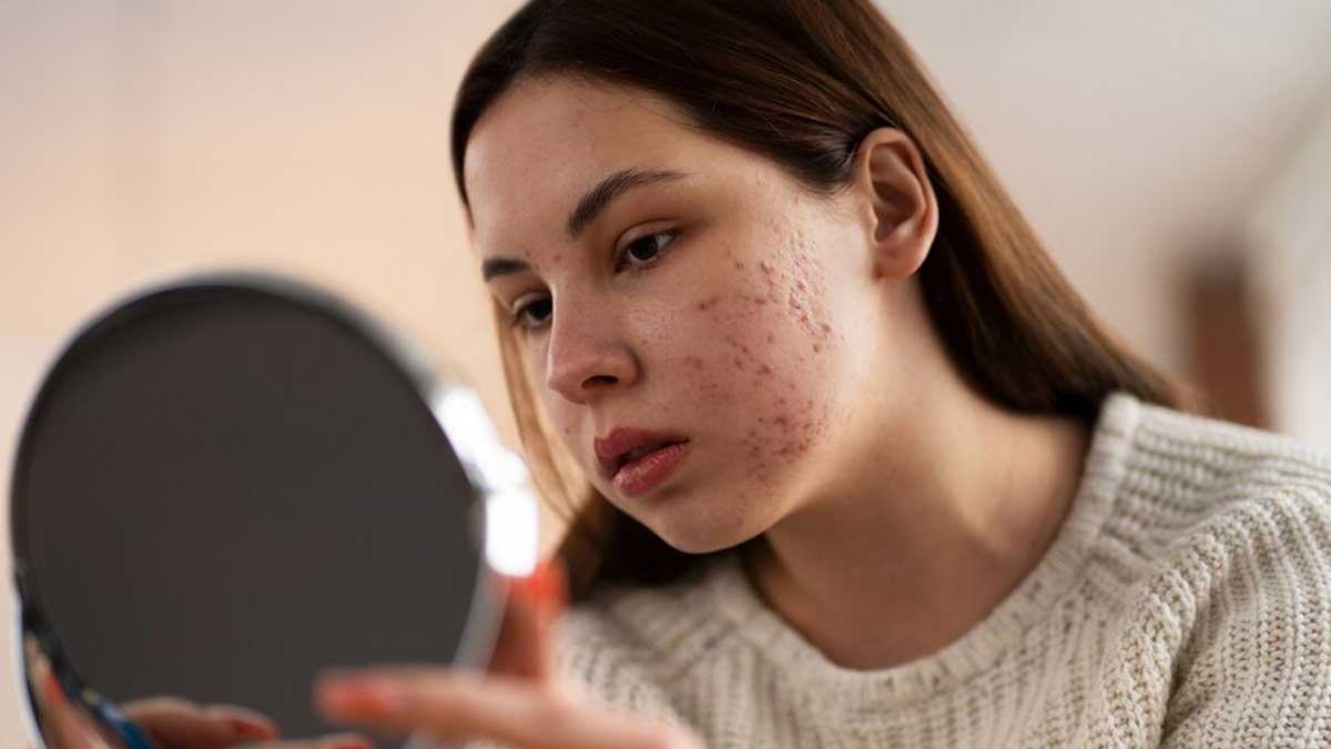 Causes Of Acne In Women You Should Know For Better Management