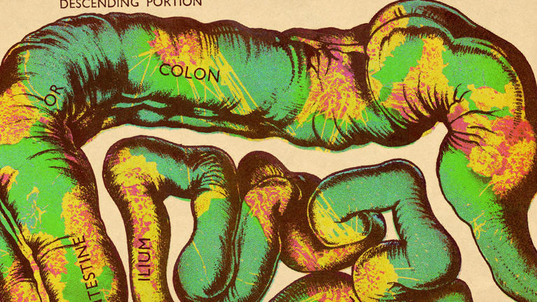 A bacterial toxin could be contributing to the colorectal cancer rise ...