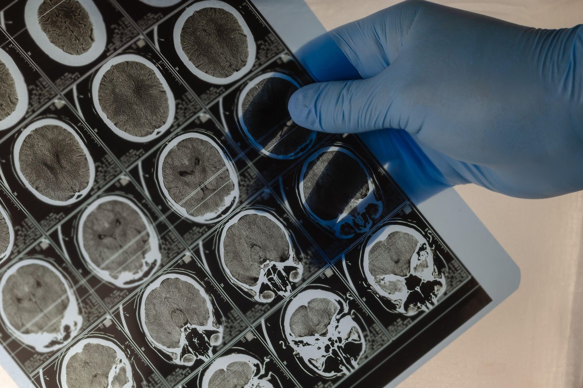 Patients blamed for ‘faking’ symptoms of underdiagnosed brain disorder