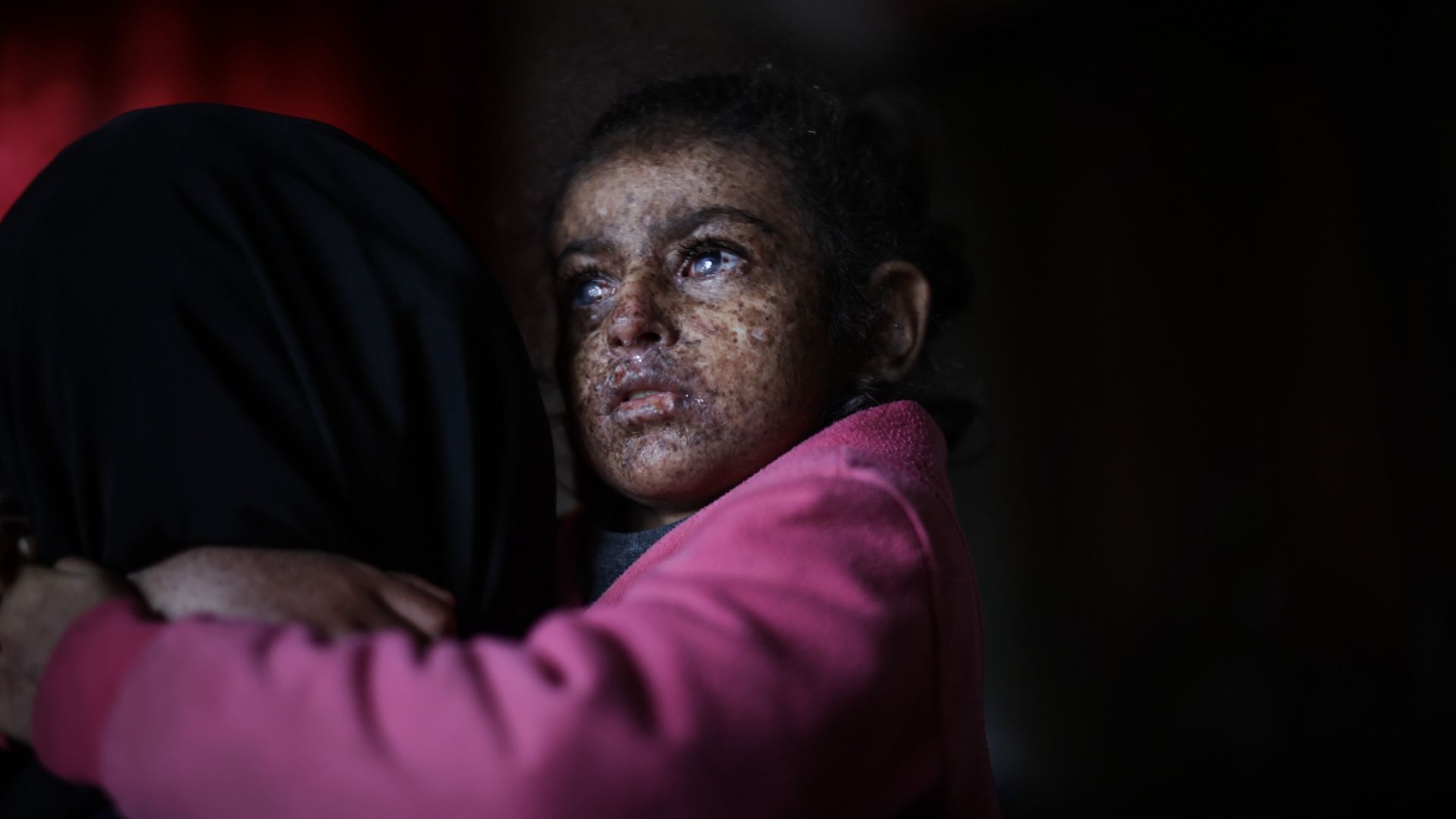 What is xeroderma pigmentosum? The rare genetic disorder that forces ...