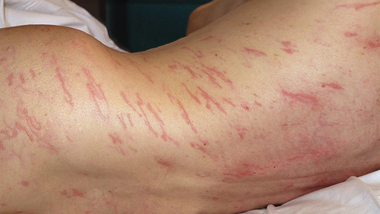 Diagnostic dilemma: A rash 'migrated' across a man's body from his anus