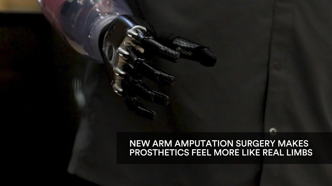 New arm amputation surgery makes prosthetics feel more like real limbs