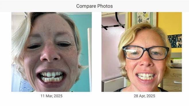 Invisalign review: How I got the smile I’ve always wanted