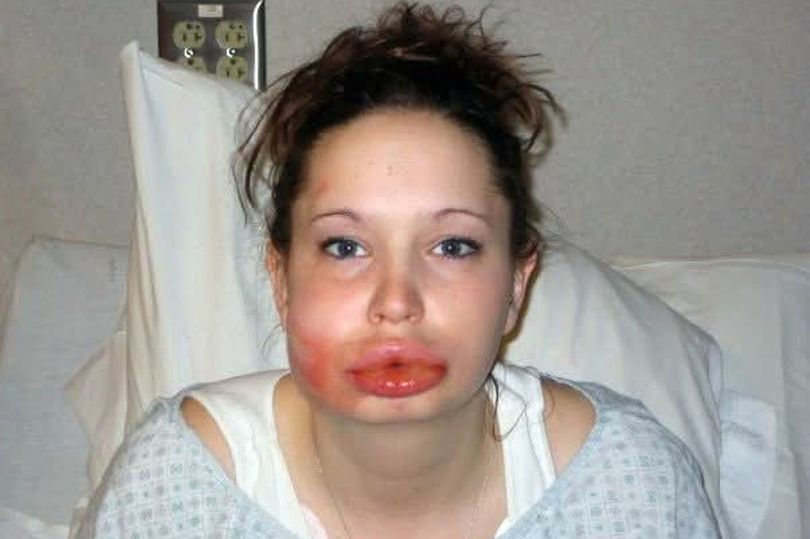 'Deadly chroming trend left my face swollen and burnt after I became ...