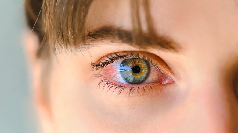 Pink Eye Vs Stye: What's The Difference?