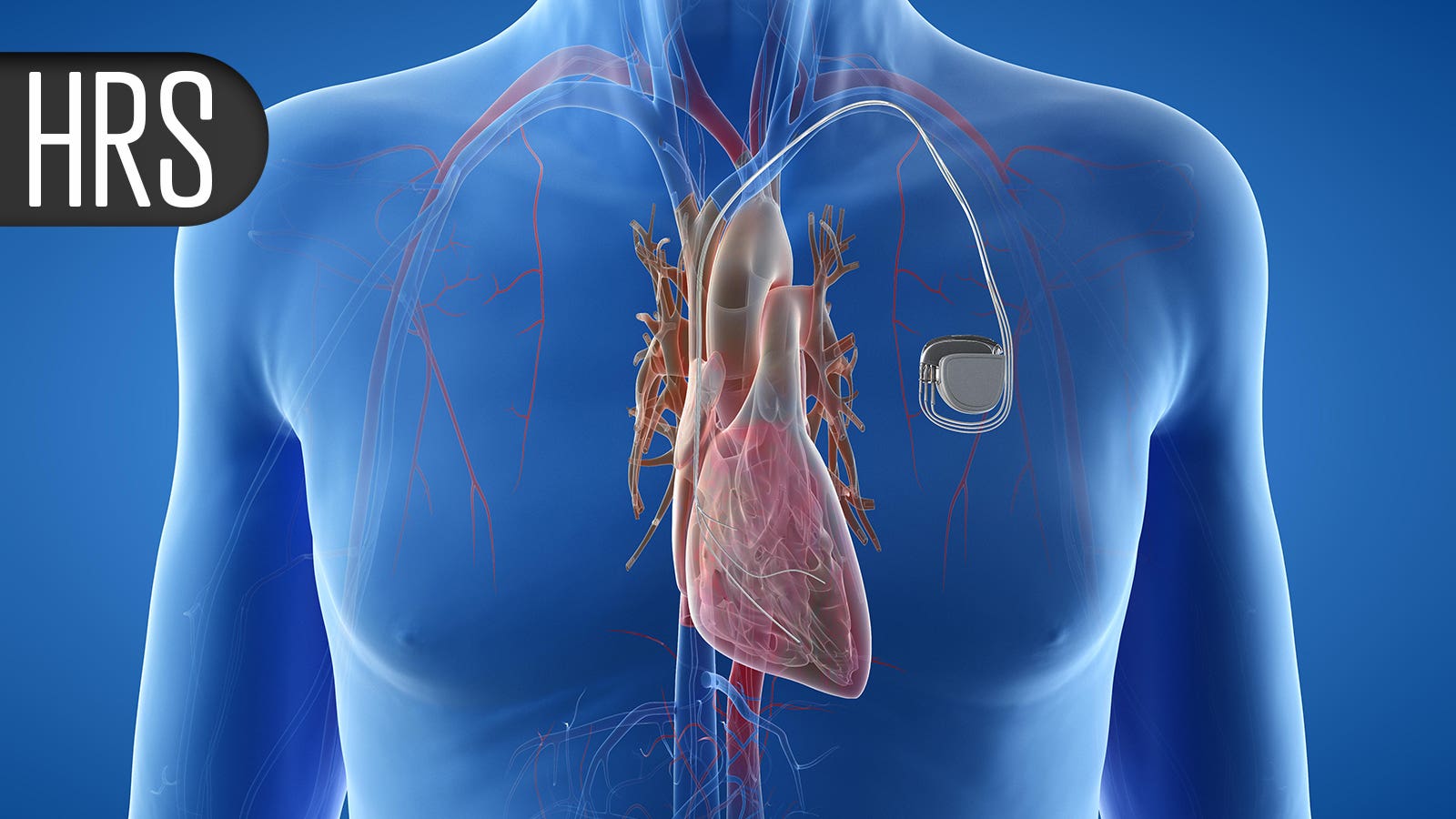 Subcutaneous ICD Ekes Out Favorable Safety Signals 8 Years Into ...