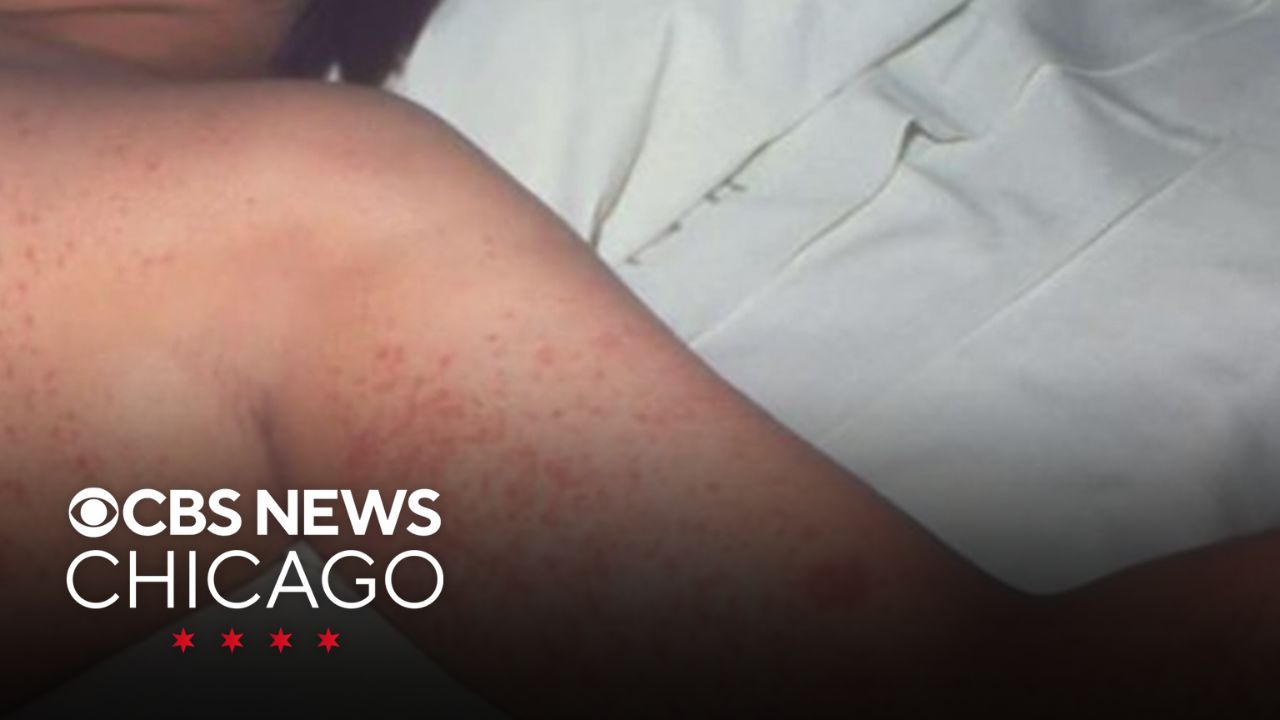 Measles cases reported in Chicago, suburban Cook County