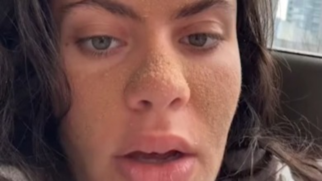 Expert's warning about viral trend that left Tia's skin 'flaking off'