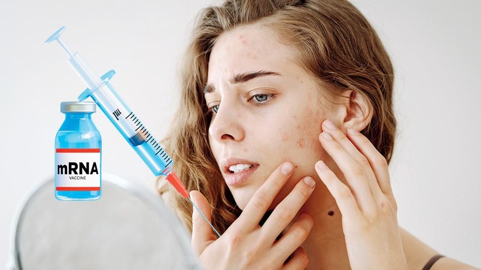 Sivilceye karşı mRNA aşısı