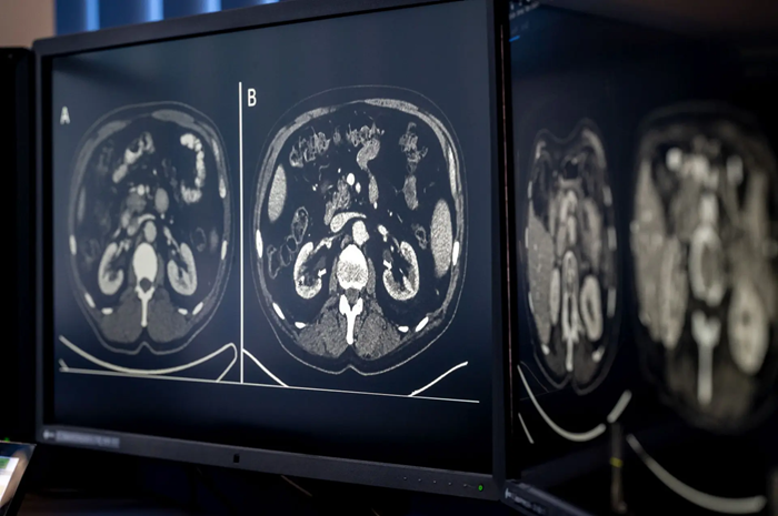 AI Analysis of CT Scans Reveals Early Kidney Damage from Cancer Treatment