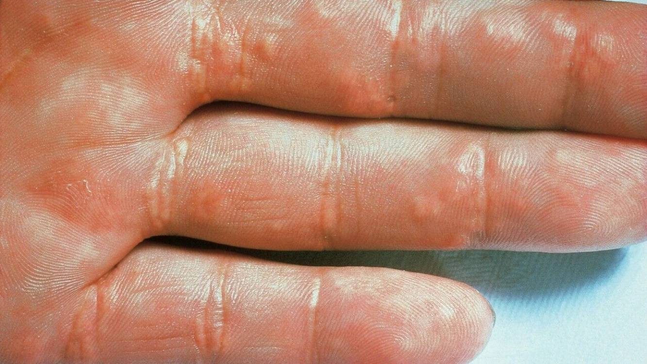 Un signe discret sur vos mains pourrait révéler un taux de cholestérol ...