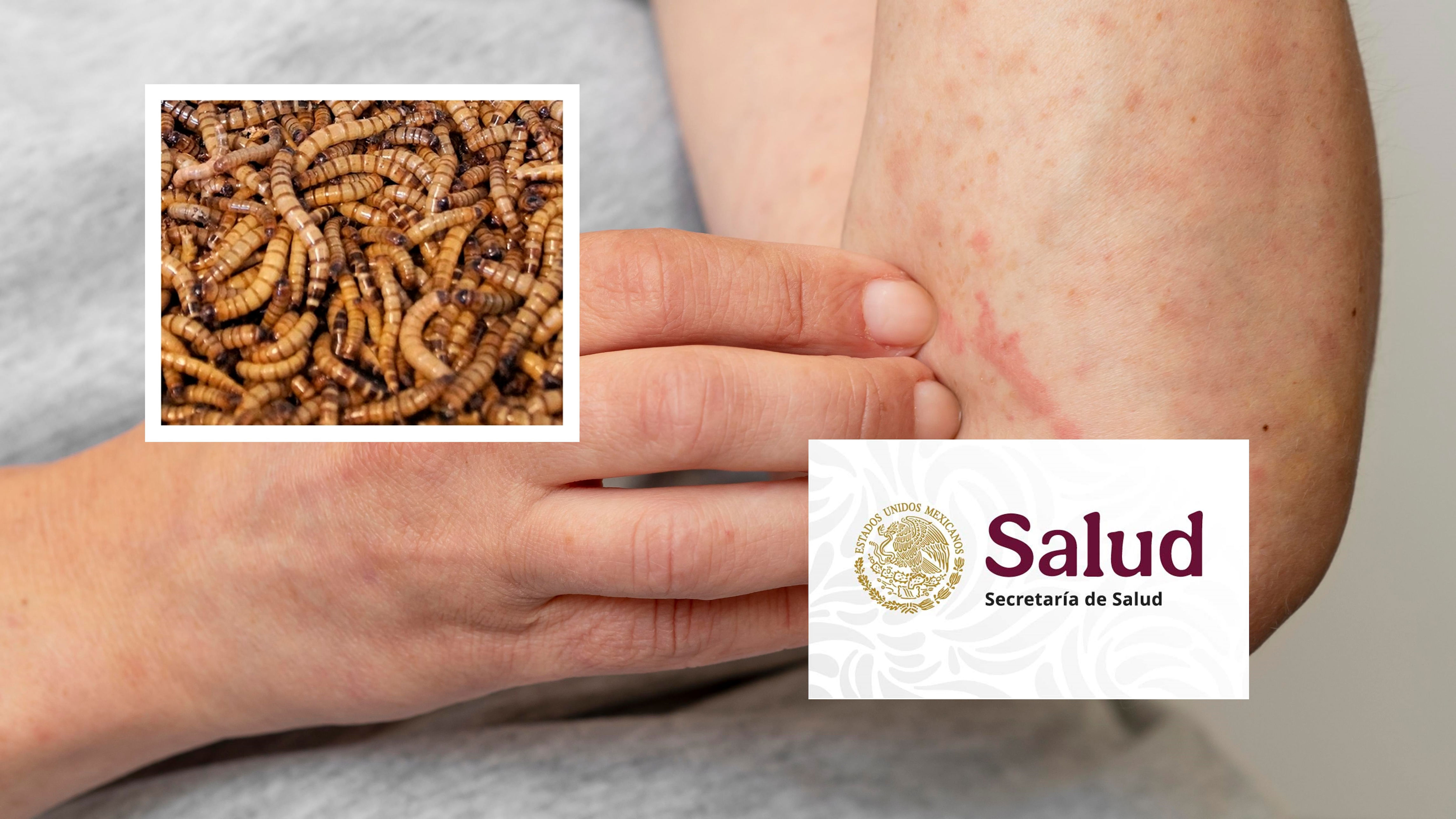 Detectan miasis, gusanos en la piel, en estos estados de México; suman ...