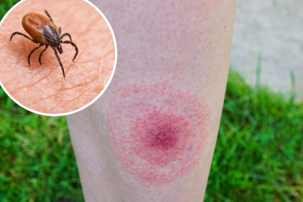Why we need to be tick aware when enjoying the great outdoors