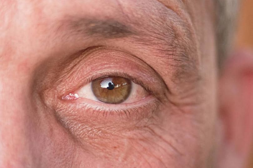 Dangerously high cholesterol could be spotted with 1 sign on the eye