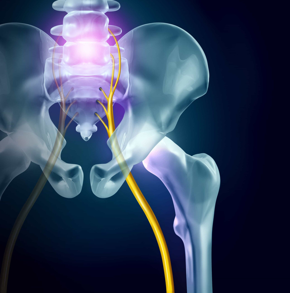 Sciatica risk factors and how to protect yourself