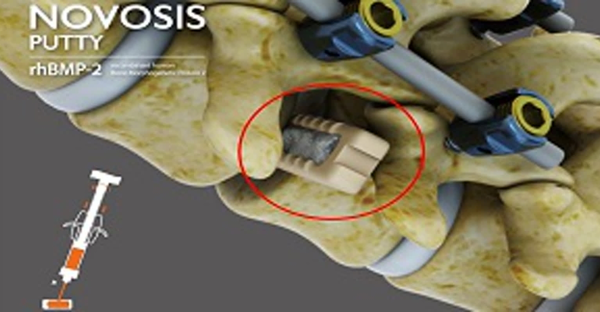 대웅 시지바이오 '노보시스 퍼티', 미국 FDA 확증임상 승인