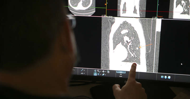 Everything you need to know about lung cancer Everything you need to know about lung cancer