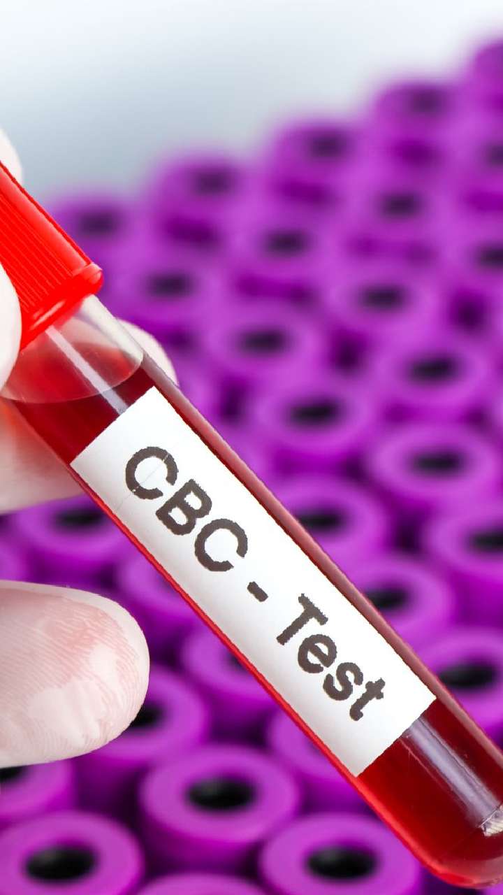 What Is A CBC Test, And Why Is It Important?