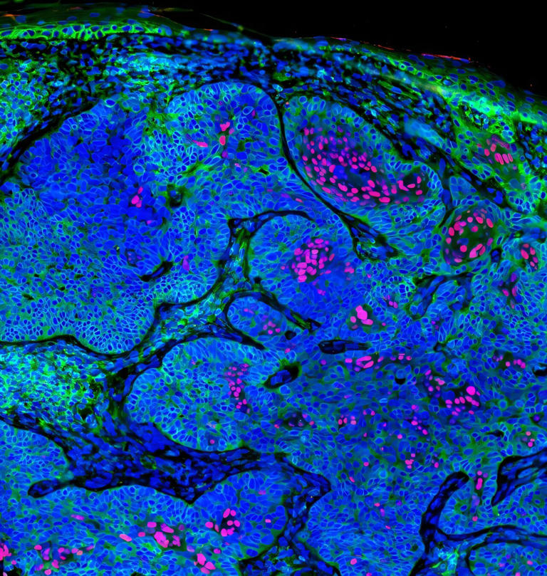 Basal cell carcinoma's low immunogenicity linked to suppression of ...