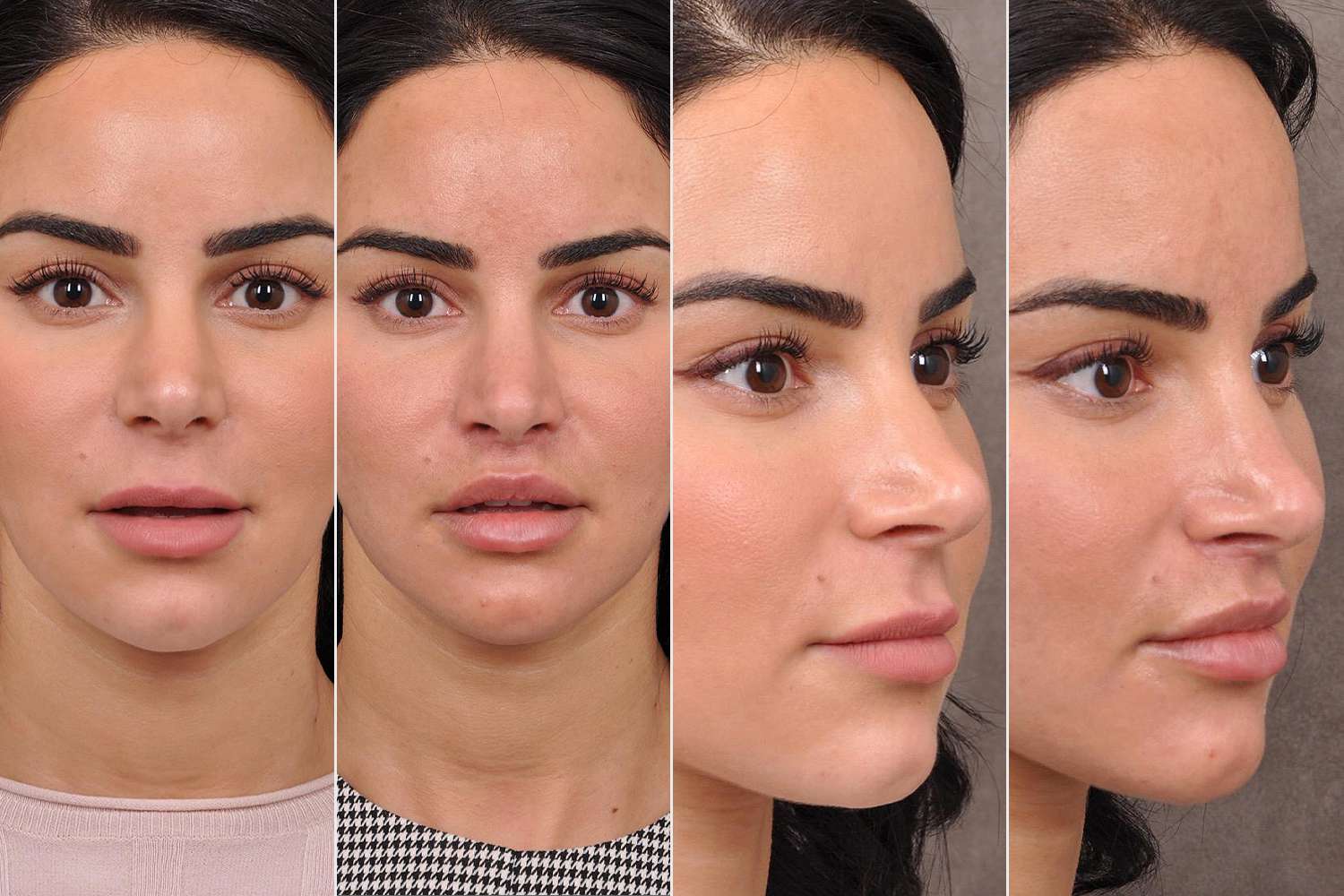 This Plastic Surgeon Uses a 'Cupid Equation' to Design Perfect Lips ...