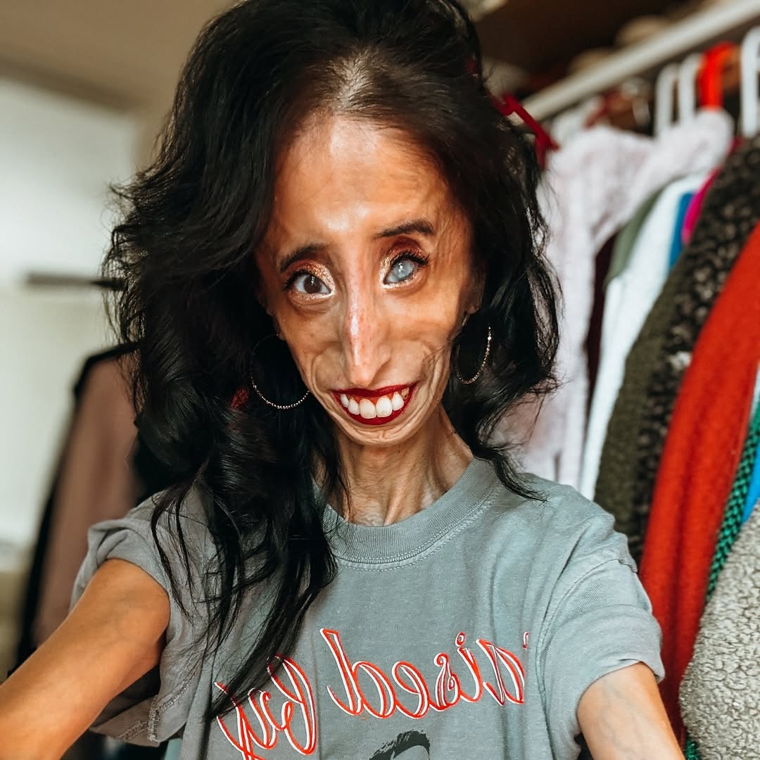 Mulher chamada de ‘a mais feia do mundo’ fala sobre síndrome rara ...