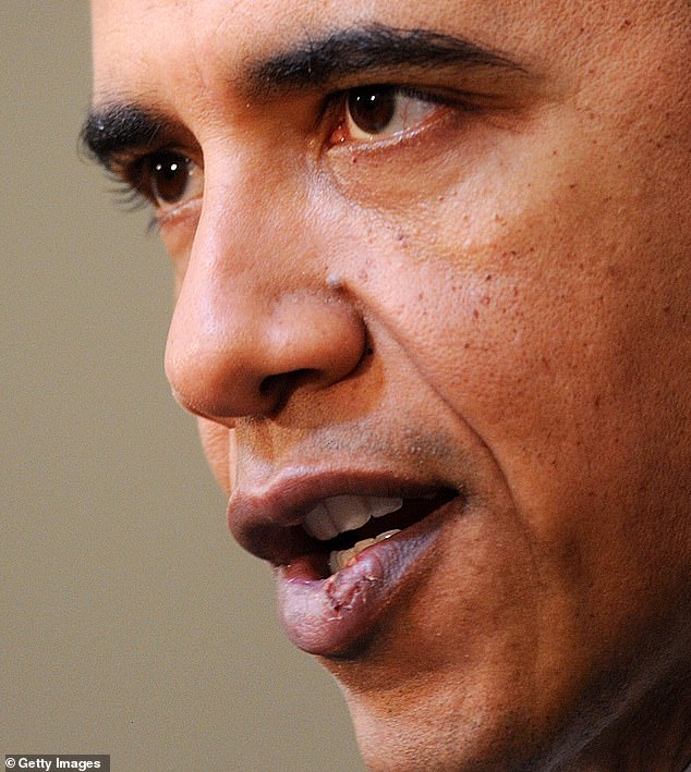 Michelle Obama reveals major medical procedure Barack underwent while ...